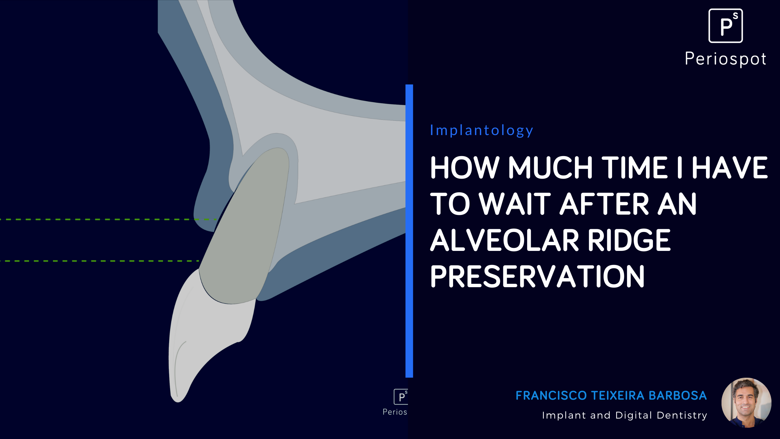 How much time I have to wait after an alveolar ridge preser | Periospot