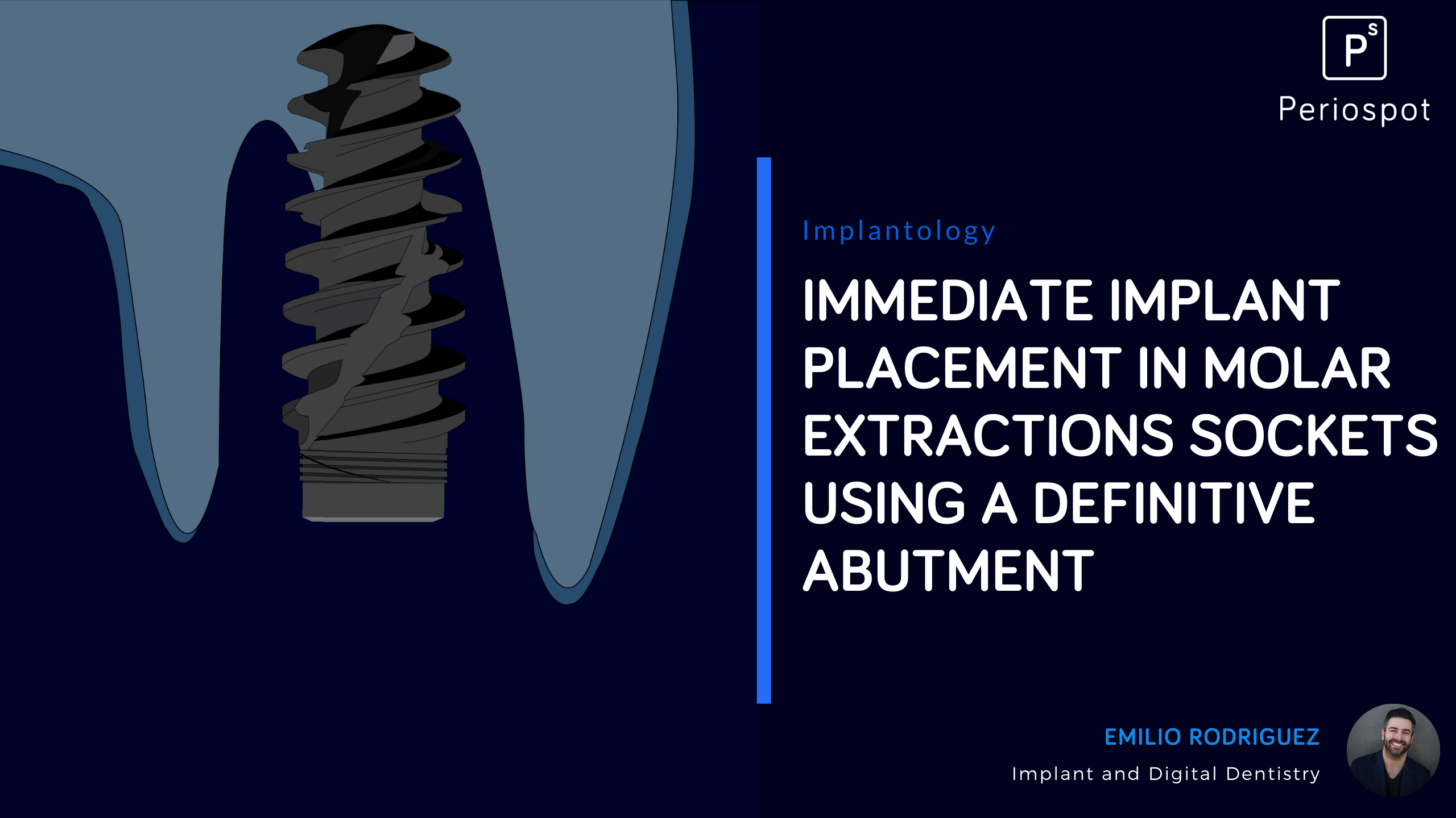 Immediate implant placement in molar extractions sockets using a ...