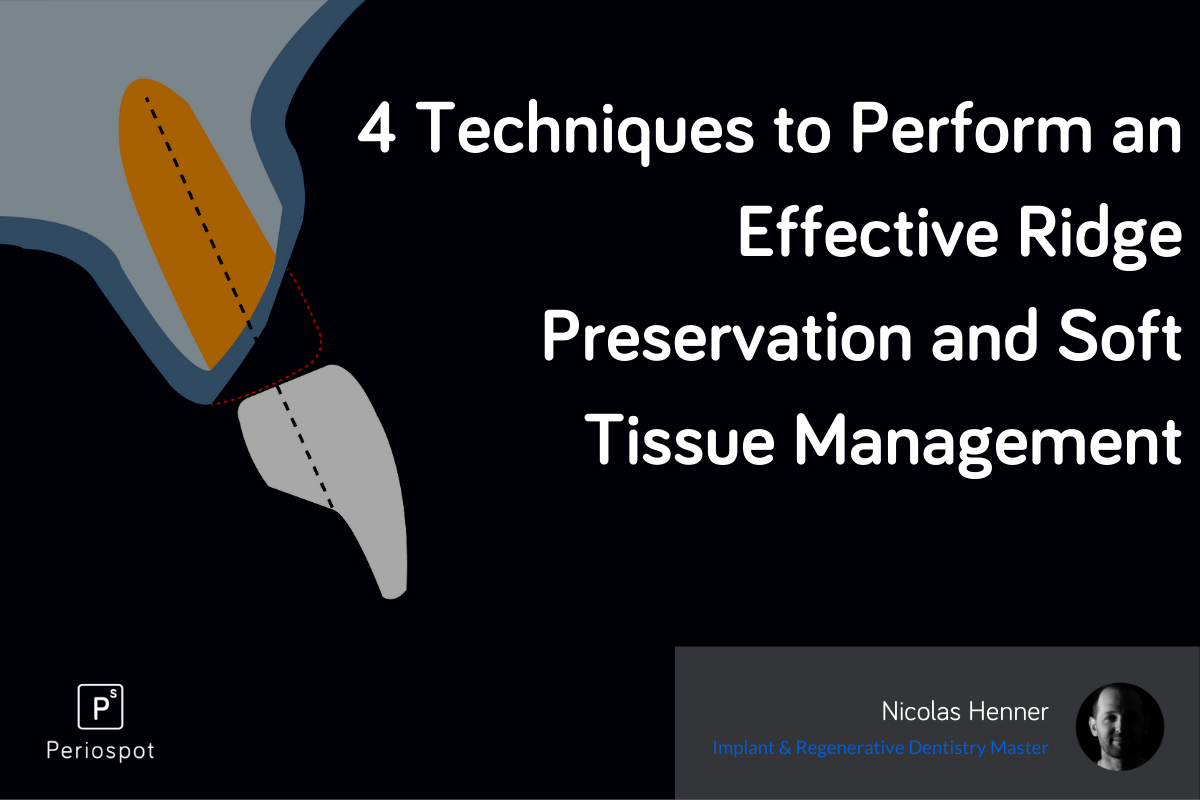 Alveolar Ridge Preservation: A Comprehensive Guide - Periospot | Periospot