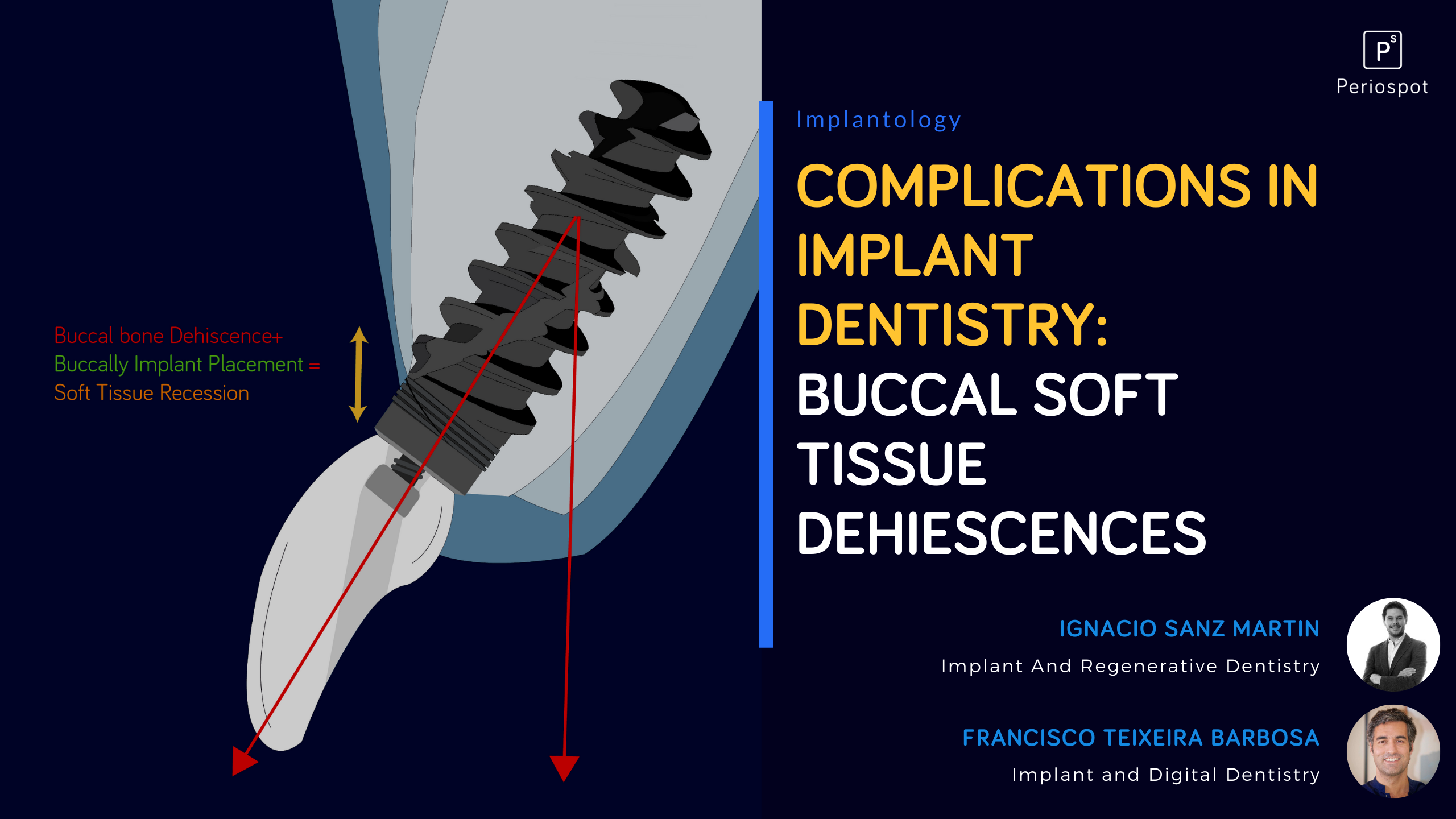 Buccal Soft Tissue Dehiscence: Causes and Solutions | Periospot